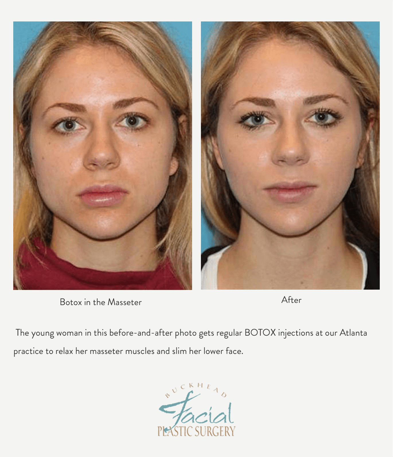 Best BOTOX® Cosmetic, Dysport® & DAXXIFY® Atlanta | Buckhead Facial ...